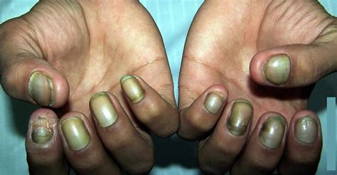 Lunula Definition Lunula Function And Nail Problems