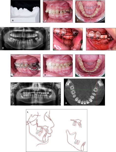 Clinical Photographs And Radiographs Of Our Case A Reduced Alveolar