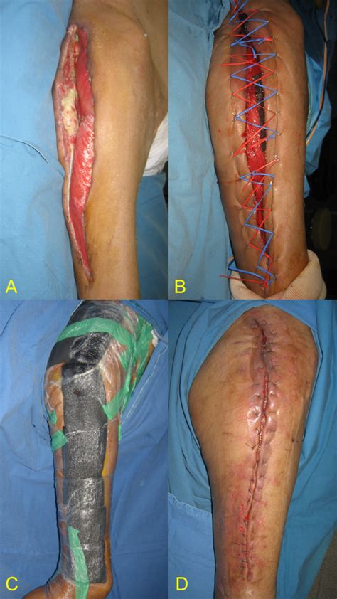 Open Fasciotomy Wound Closure With Extended Npwt Assisted Download
