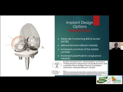 Free Video Kinematic Alignment Vs Kinematic Implants In Total Knee