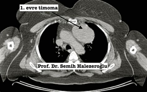 Timoma Teşhis Ve Tedavisi Semih Halezeroglu