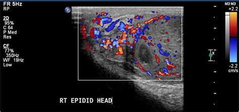 Doppler Ultrasound Image Showing The Severe Hyperemia Also Involving