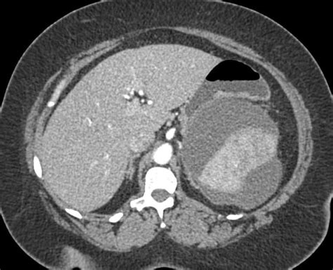 Ctisus On Linkedin Splenic Laceration With Subcapsular Hematoma