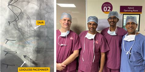 What Is A Leadless Pacemaker Benefits And Procedure Advanced Heart