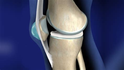 Ortho Blog Prepatellar Bursitis Kneecap Bursitis Video