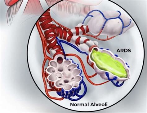 Acute Respiratory Distress Syndrome Ards Nysora