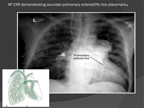 Ppt More Cxr… Powerpoint Presentation Free Download Id 6642592