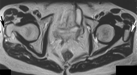 Mri Diagnosis Of Tears Of The Hip Abductor Tendons Gluteus Medius And Gluteus Minimus Ajr