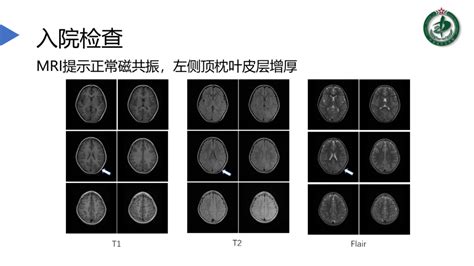 【华科·精准病例夹】一例枕叶癫痫的诊疗过程——中部战区总医院宋健 脑医汇