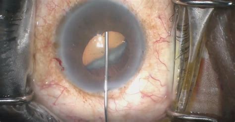 Removal Of Cataract In Patient With Ectopia Lentis Et Pupillae Eyetube