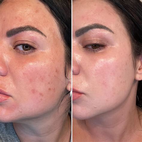 Botox Injections For Hyperhidrosis Say Goodbye To Sweat