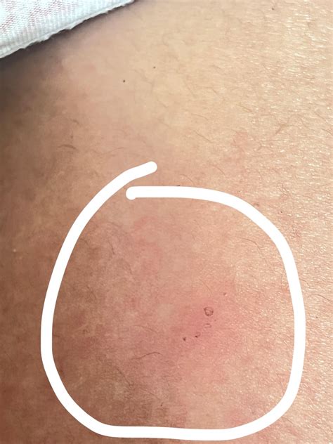What Bug Bites Look Like This Rbugbites