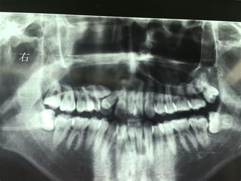 颌骨囊肿的治疗方案 医联