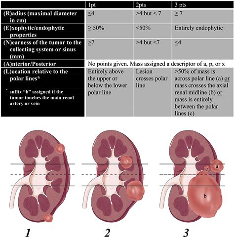 Partial Nephrectomy Contemporary Outcomes Candidate Selection And