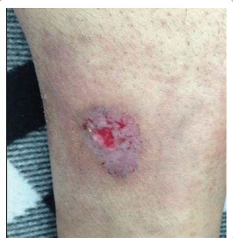 Clinical Image Ulceration In The Leg Case 1 Download Scientific