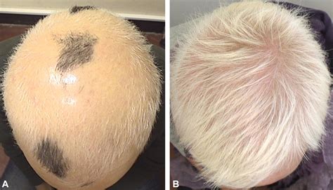 White Hair In Alopecia Areata Clinical Forms And Proposed