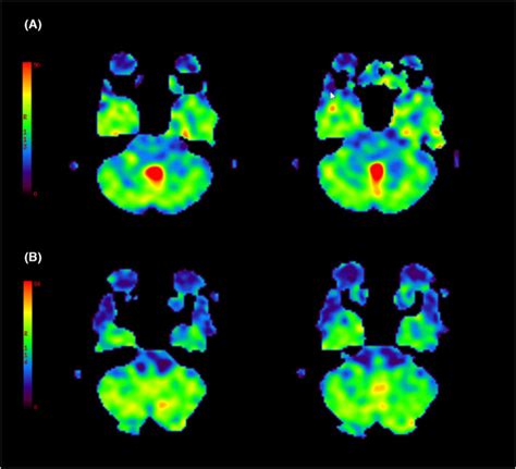 Arterial Spin Labeling Hyperintensity At Cerebellar Nodulus Possible