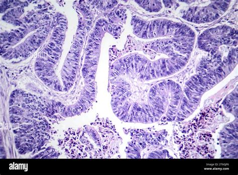 Photomicrograph Of Esophageal Squamous Cell Carcinoma Showing