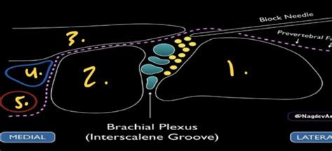 Upper Extremity Blocks 9 6 Flashcards Quizlet