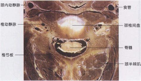 颈椎椎管 脊柱外科临床解剖 医学
