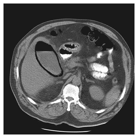 Emphysematous Cholecystitis New England Journal Of Medicine