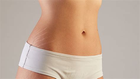 Stretch Marks Removal Treatment At Eudermiz