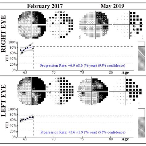 Visual Field Test Using The Humphrey Field Analyzer And 30 2 Algorithm