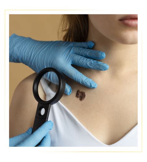 Skin Tag And Birthmarks Removal Skinature Clinic
