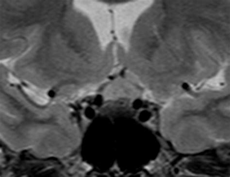 Tuberculum Sellae Meningioma