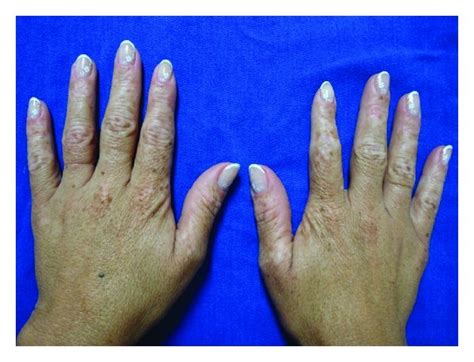 Hyper And Hypopigmented Macules Distributed Symmetrically On The