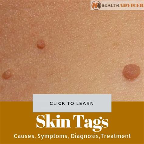 Skin Tags Causes Picture Symptoms And Treatment