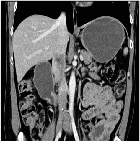 Computed Tomography Scan Showing Dilation Of The Stomach And Duodenal Download Scientific