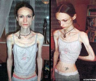 Frente Al Espejo Anorexia
