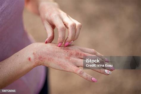 Dermatitis Eksim Di Tangan Dan Kaki Bintikbintik Merah Pada Kulit Kulit