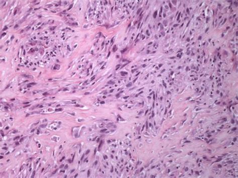 Malignant Lace Like Osteoid Formation Notice The Nuclear Polymorphism Download Scientific