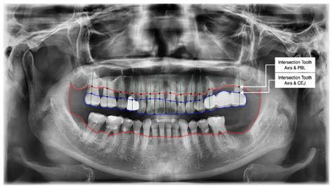 Pbl And Cej Intersection With The Tooth Main Axis Download
