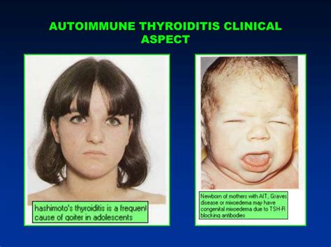 Autoimmune Thyroiditis