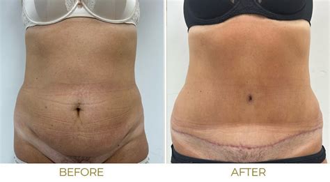 Tummy Tuck Before And After Stretch Marks