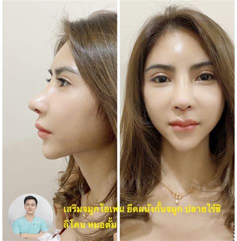 แ หมอตั้ม รวมรีวิว เสริมจมูก ตาสองขั้น ปากกระจับ เสริมคาง