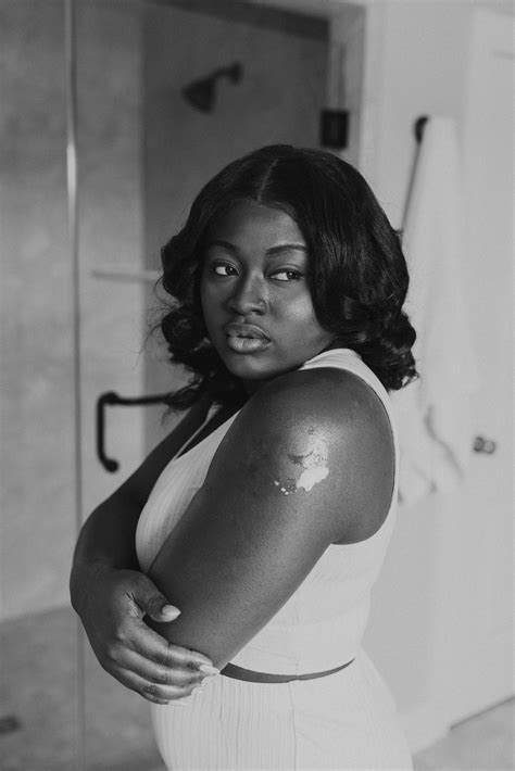 10 Things That Are Causing Your Eczema Worsen