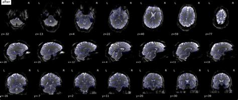Fsls Topup Implementation Fmriprep 21 Significantly Worse Than