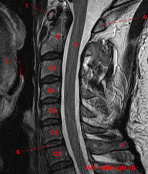 Cervical Spine Mri Anatomy W Radiology