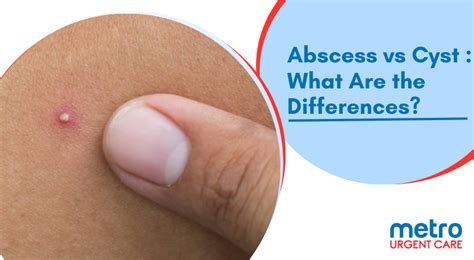 Difference Between Cyst And Abscess Splenic Cysts Abscess And Tumors
