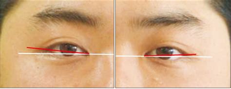 Diagnostic Analysis Of Vertical Orbital Dystopia And Canthal Tilt For