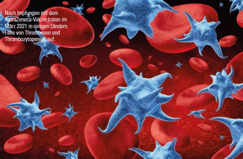 Case Report Vakzininduzierteprothrombotische Immunthrombozytopenie