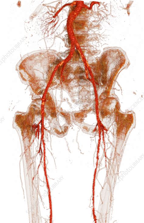Atherosclerosis In Legs Ct Angiogram Stock Image C061 3265 Science Photo Library