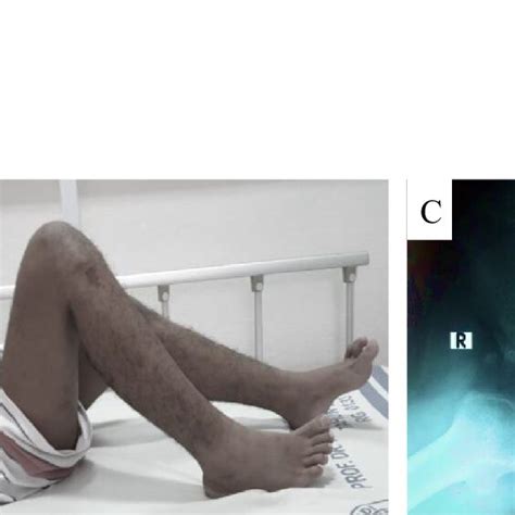 Preoperative Clinical And Plain Radiograph A Anteroposterior View Of