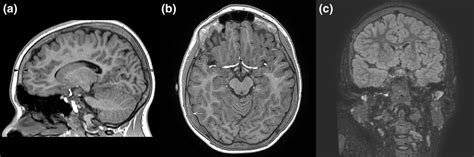 Head Mri 15 T In A 10‐year‐old Girl Consistent With Red Marrow