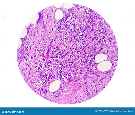 Photomicrograph Of Granulomatous Tissue Histolog 278142837