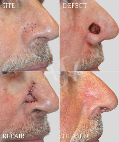 Mohs Nose Reconstruction Results American Skin Institute